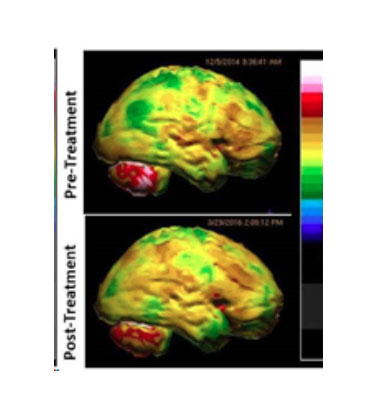 Parkinsons | Neuro-Luminance Brain Health Center
